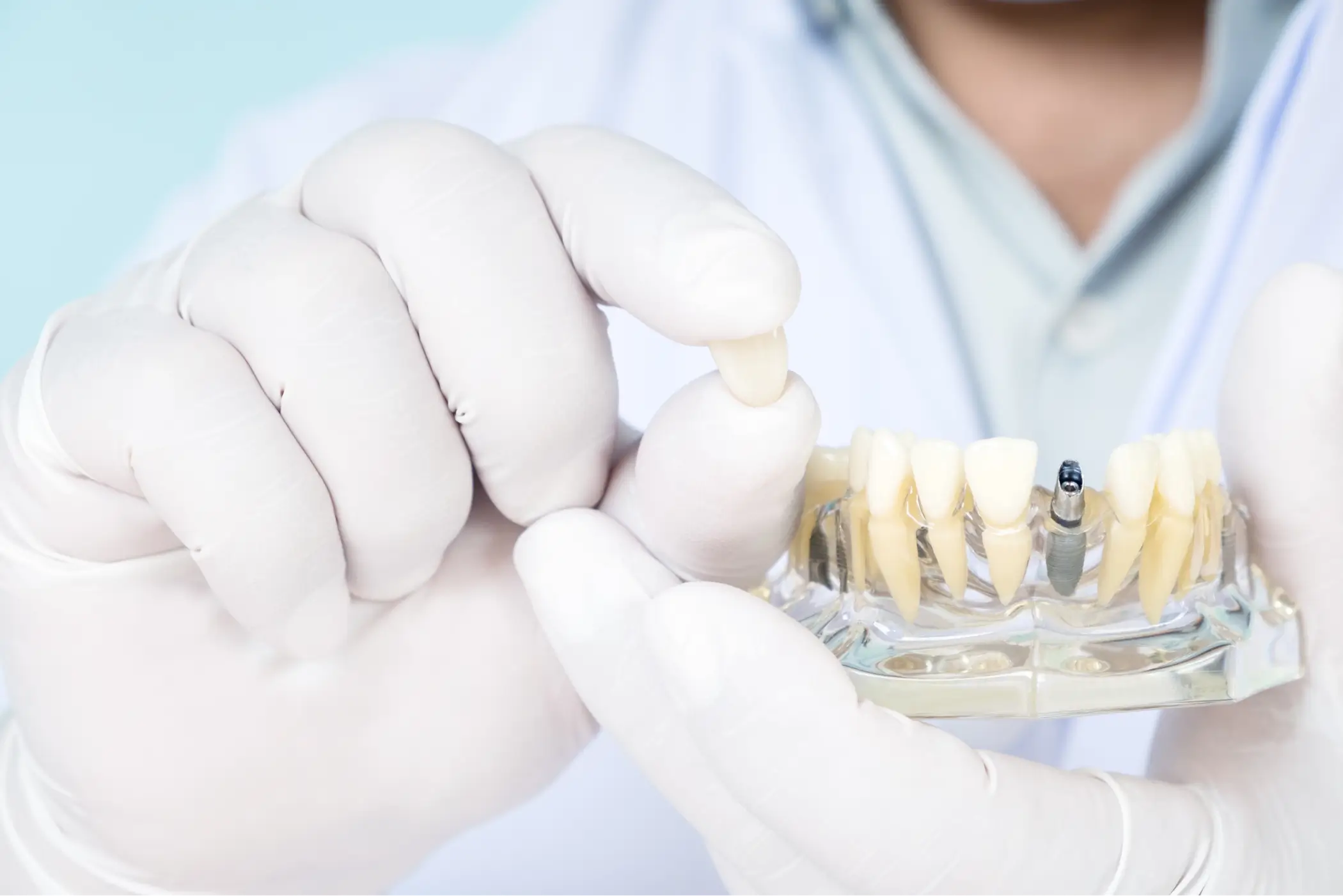 Dental Crowns: What You Need to Know